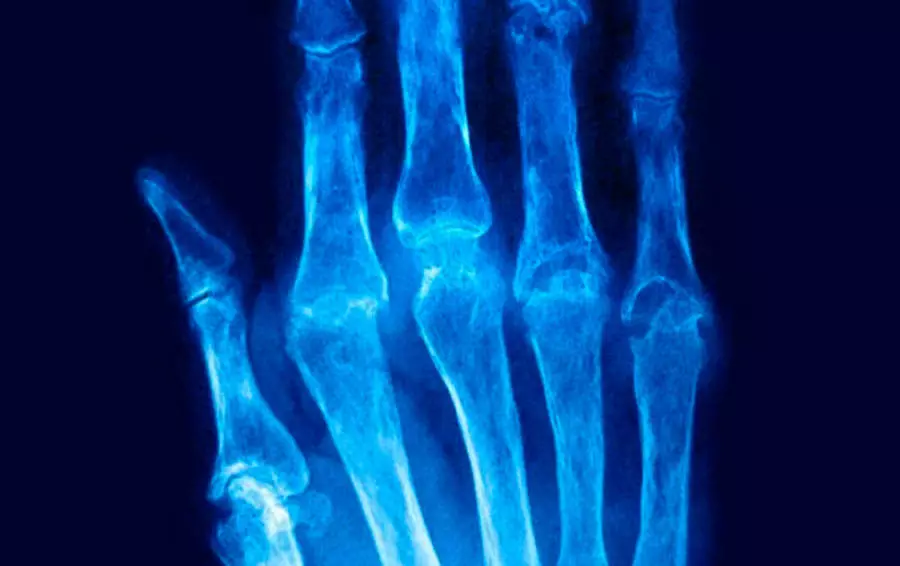 Arthritis