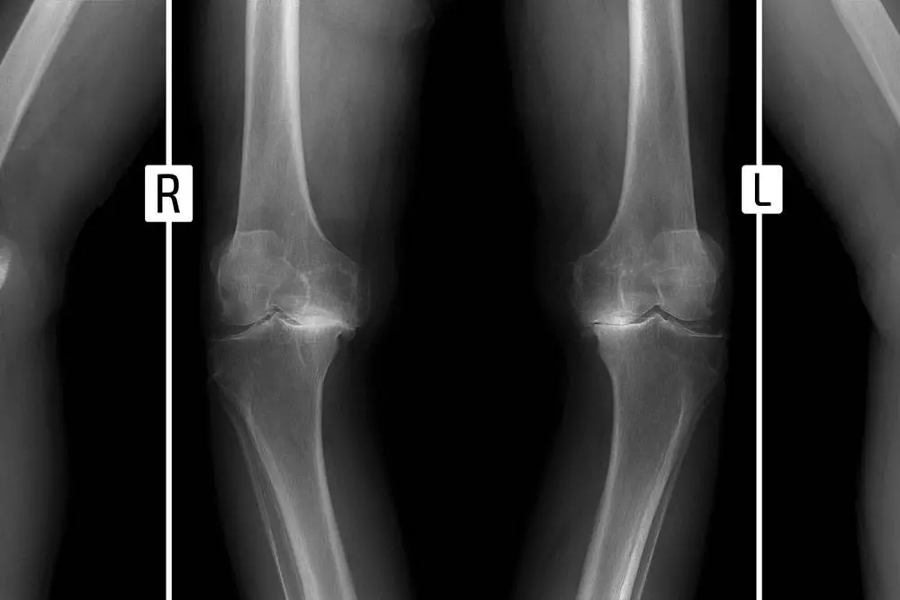 Alasan Osteoarthritis