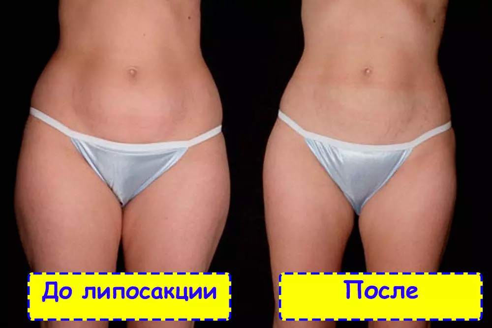 before and after liposuction