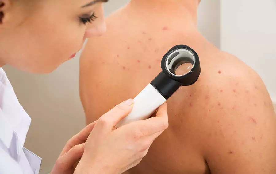 Desenvolvemento de inflamación en extrusión acne