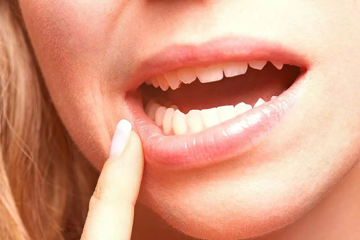 Foto - Hoe om stomatitis te behandel